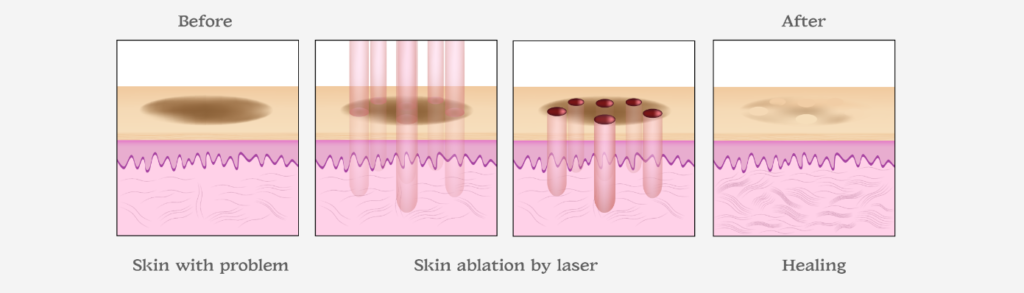 Laser CO2 Fractional MultiXel (DS-40UB) - NC Medical