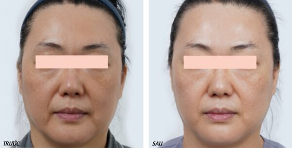 HIFU Shurink Universe (ULTRAFORMER MPT) - NC Medical