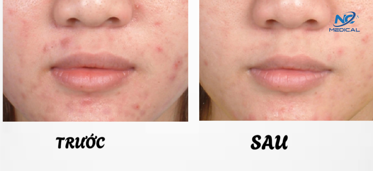 Laser Lutronic Spectra XT - NC Medical