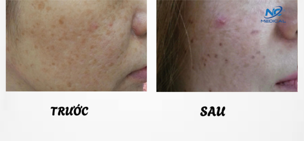 Laser Lutronic Spectra XT - NC Medical