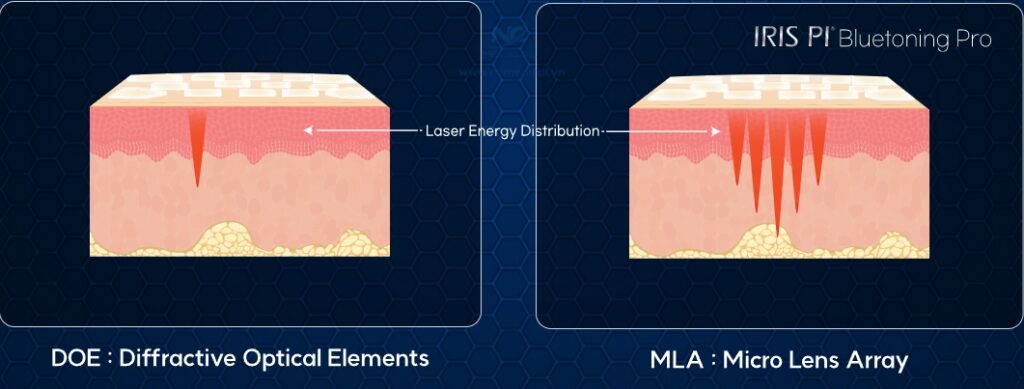 IRIS PI - NC Medical