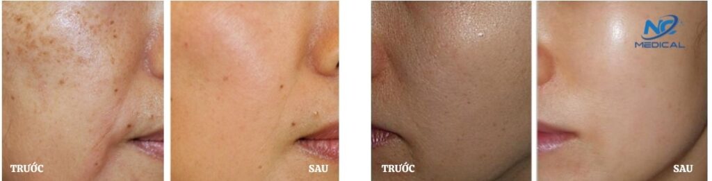 IRIS PI - NC Medical